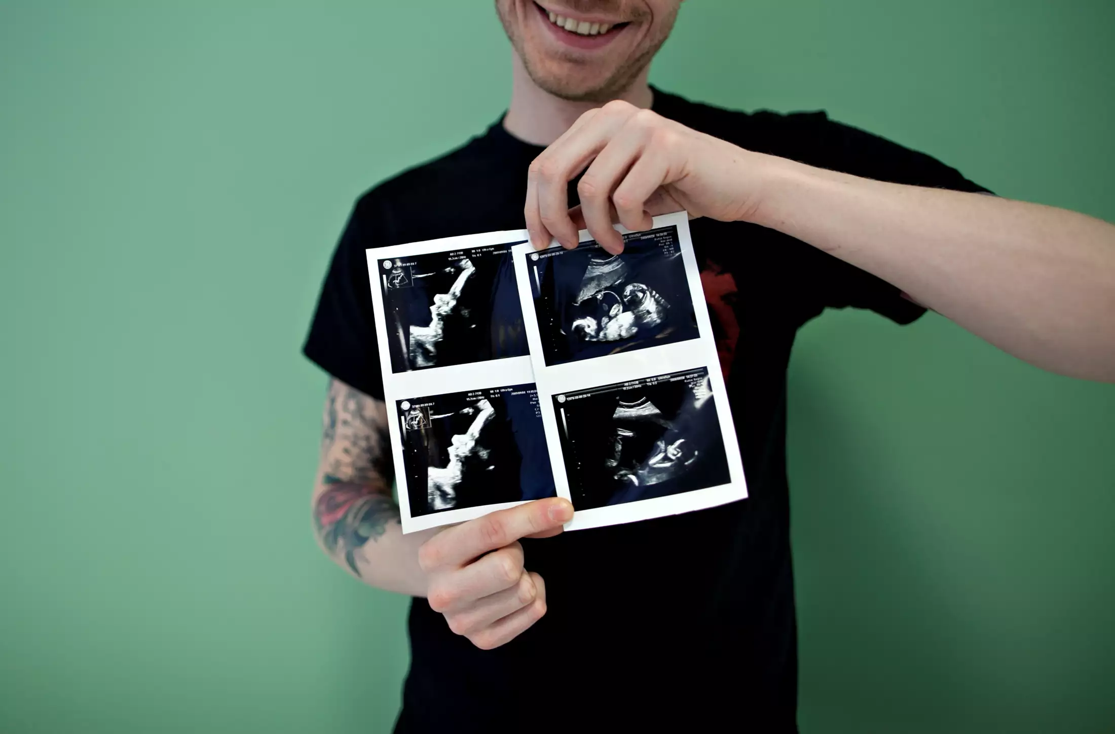 Att vara gravid med tvillingar - 1177